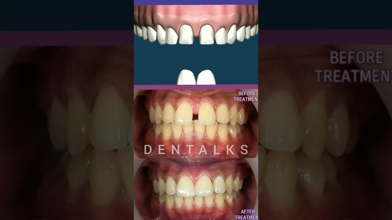#veneers Worried about Gap between Front Tooth ?? Dental Veneers | Patient Education Animation