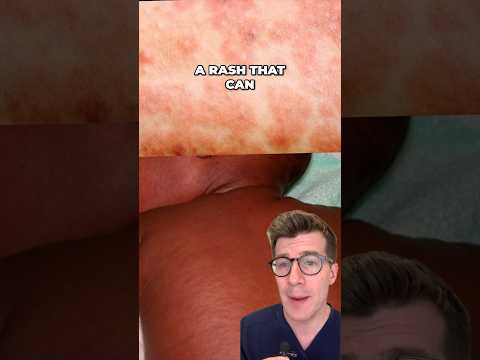 Measles rash - what it looks like on different skin types #shorts #health