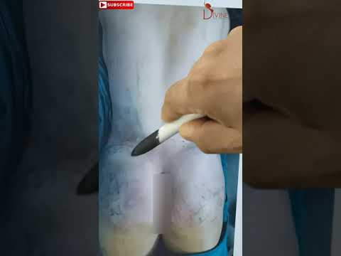 Vaser 360° High Definition Procedure for Back Liposuction & BBL Marking