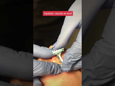 How dermatologists remove moles. #shorts