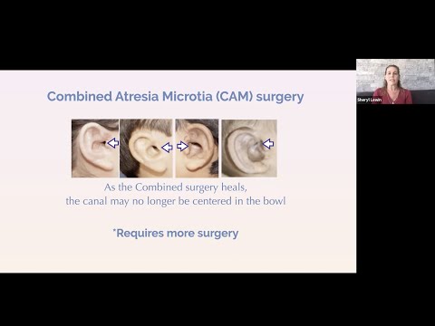 Live Chat - Q&A with Dr. Sheryl Lewin on Porous Implant Ear Reconstruction for Microtia