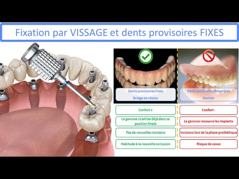 All on 4 - Fixation par vissage et dents provisoires fixes