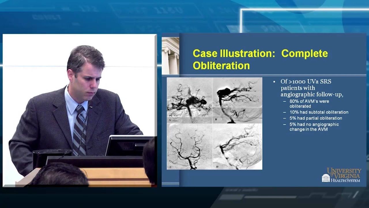 Radiosurgery for Arteriovenous Malformations
