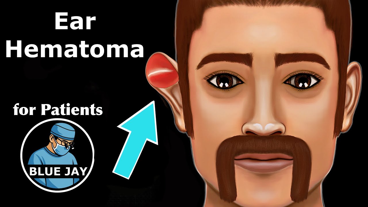 Ear Hematoma: Patient Education