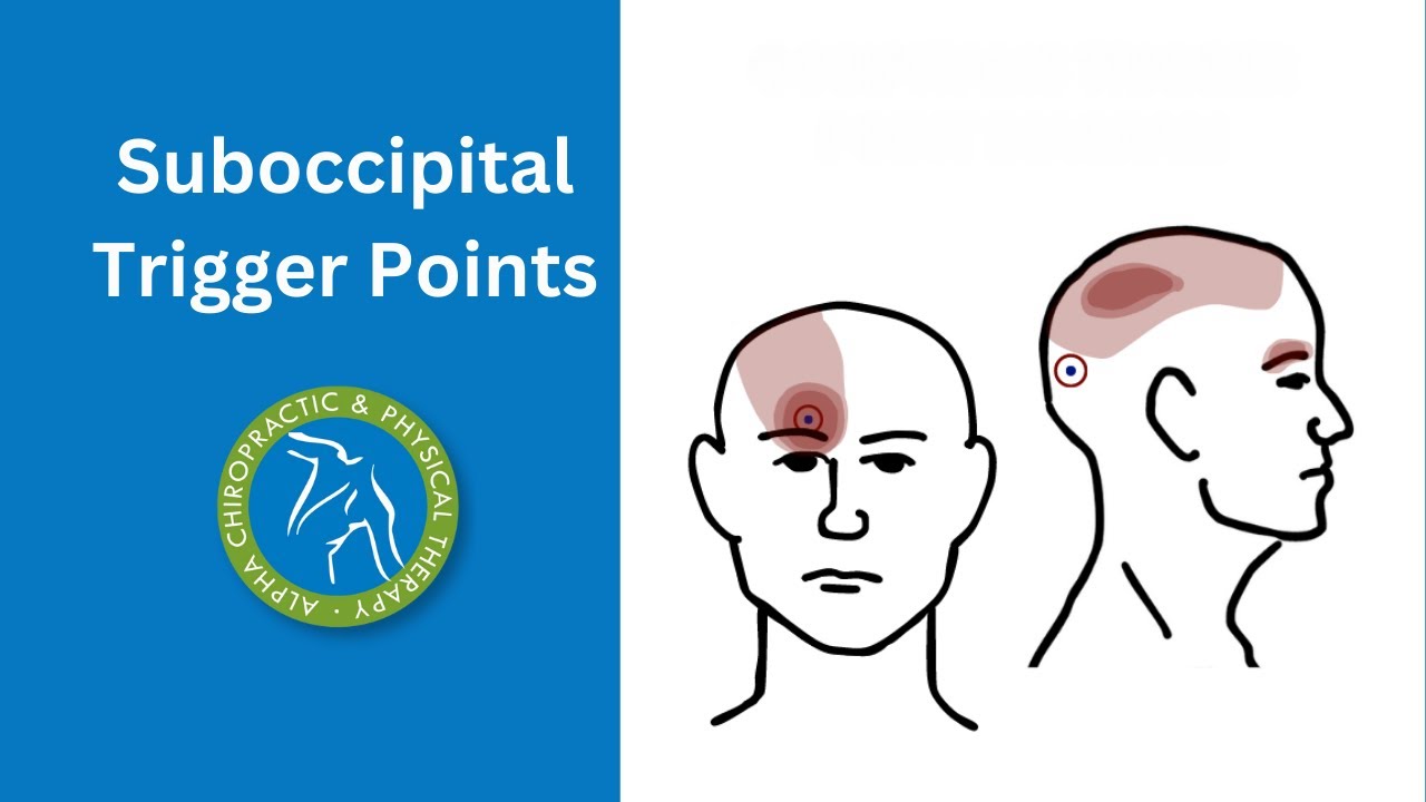 Suboccipital Trigger Point Pain & Treatment