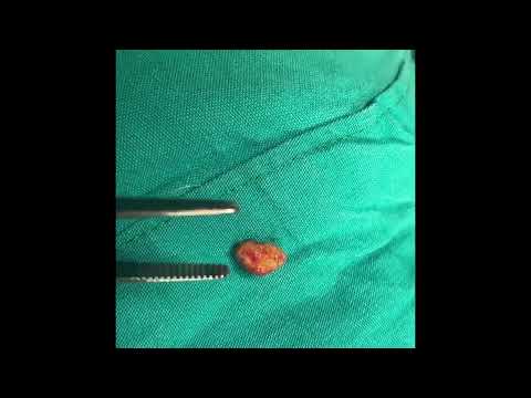parotid gland sialolith,tükrük bezi taşı