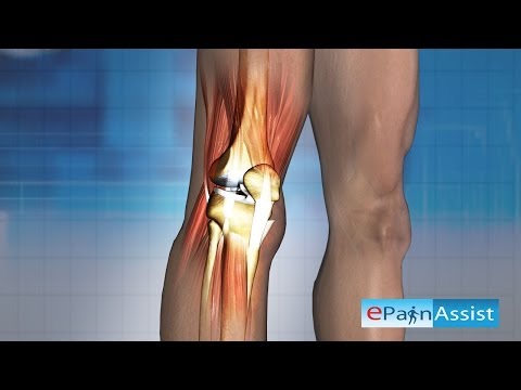 What is Knee Arthroscopy & How is it Done?