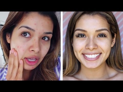 How do I get rid of acne (step by step!) | ItsMandarin – Health