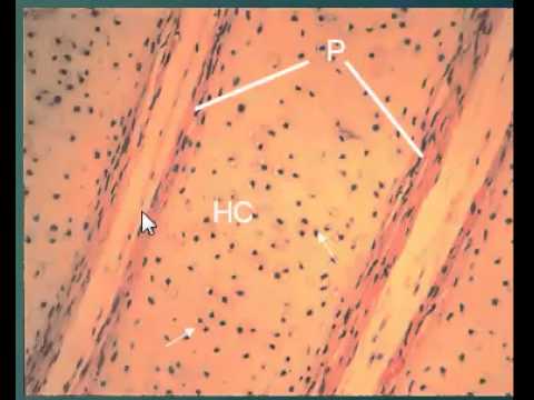 Hyaline cartilage bordered by dense regular connective tissue
