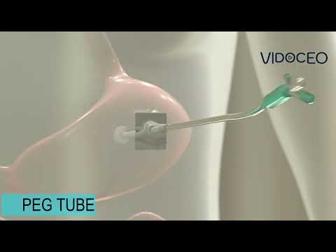 Percutaneous Endoscopic Gastrostomy (PEG) feeding tube animated explanation