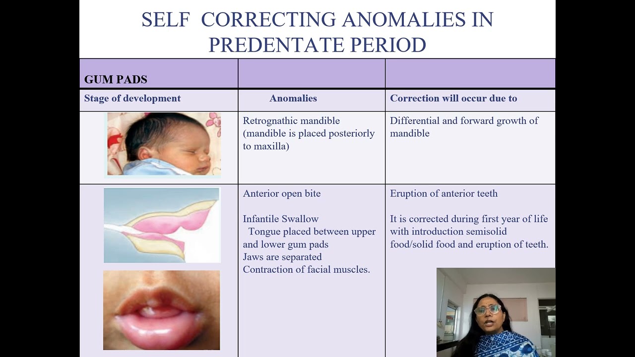 BDS 405 SELF CORRECTING ANOMALIES IN PRIMARY DENTITION