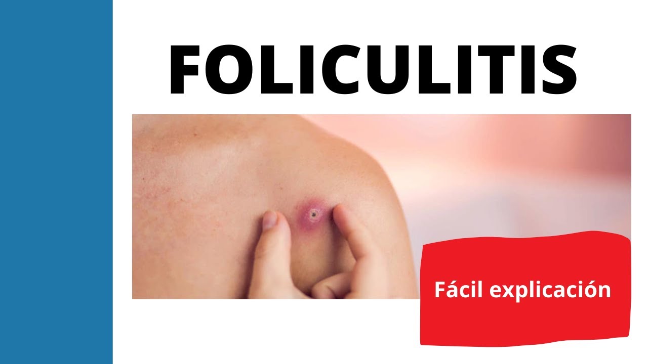 Foliculitis (resumen y fácil explicación), Arenas 7ma edición