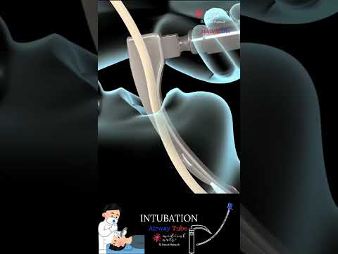 Intubation - EndoTracheal Tube - Breathing Tube #medicalanimation