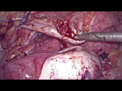 Step by Step Guide to Laparoscopic Ureteric Re-Implantation