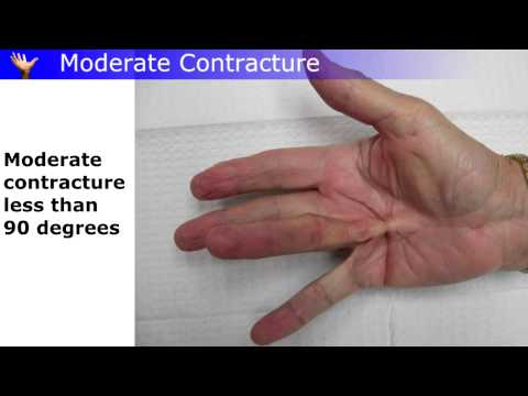 What Does Dupuytren's Look Like?