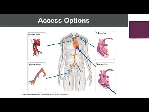 Learn about transcatheter aortic valve replacement (TAVR)