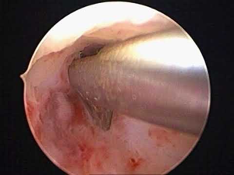 HYSTEROSCOPIC REMOVAL OF ADHESIONS AT INTERNAL OS