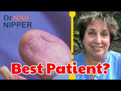 Severely Long Toenails and a Spouse's Story (2020)