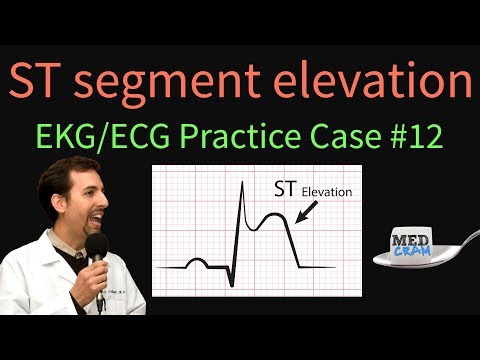 ST Elevation - EKG / ECG Interpretation Case 12 (STEMI, MI, ACS)