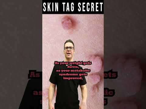 How To FIX Skin Tags FOREVER!