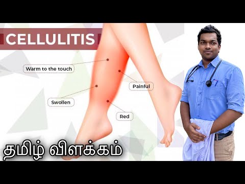 Cellulitis explained in Tamil - Dr Aaron