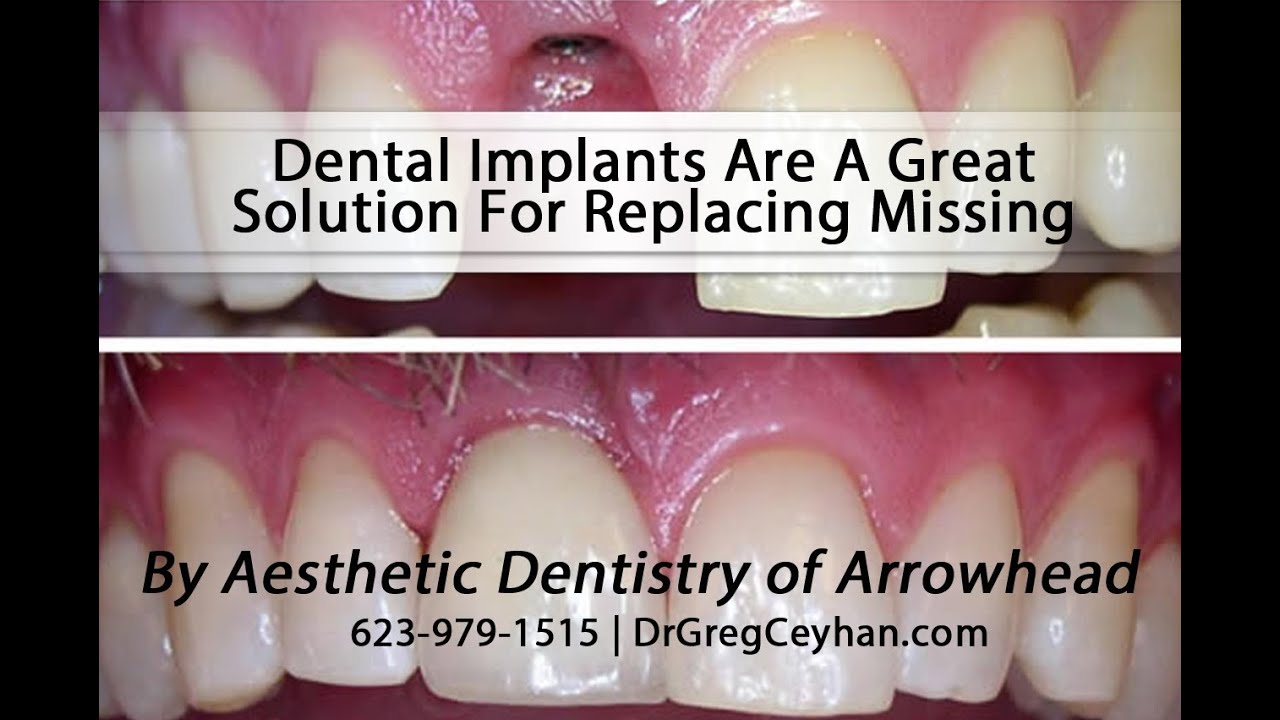 Why Dental Implants Are A Great Solution For Replacing Missing Teeth
