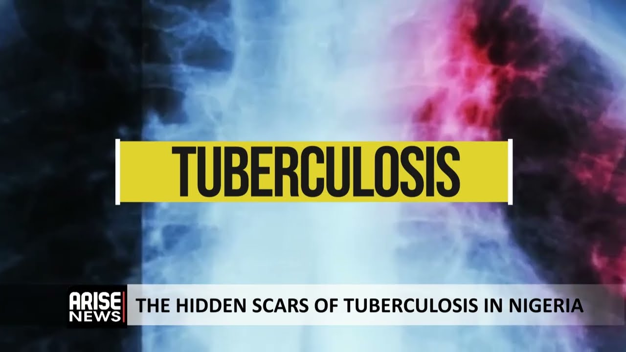 COMMEMORATING WORLD TB DAY 2026
