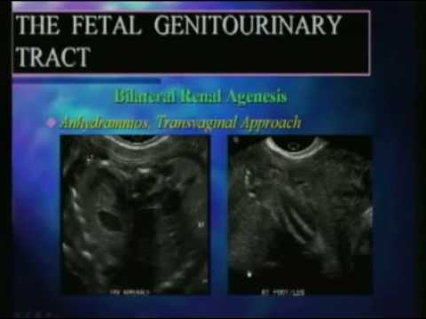The Fetal Genitourinary Tract