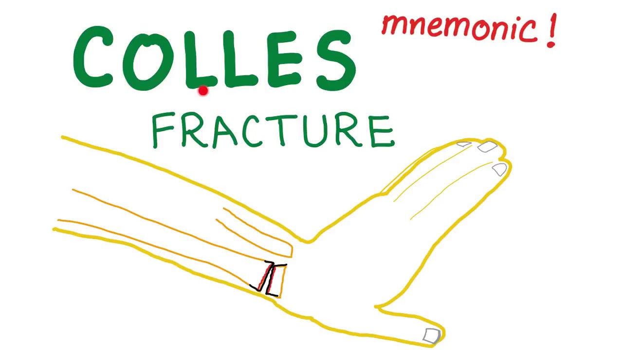 Bone Fractures - Colles Fracture Mnemonic - Orthopaedics