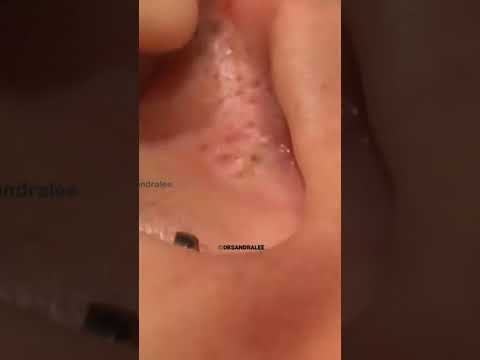 Ear Blackhead #asmrsounds | Dr. Pimple Popper #shorts #pimples #oddlysatisfying