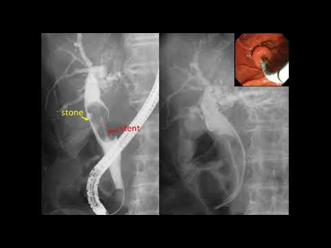 Removal of a biliary stent encrusted with a large stone by use of cholangioscope with a holmium