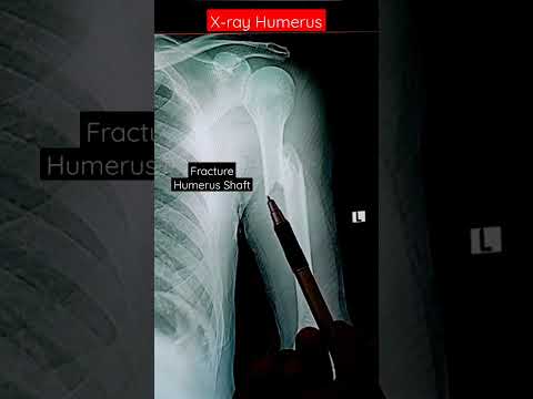 Fracture Humerus Bone | X-ray Arm #humerus #shorts #xray #radiography