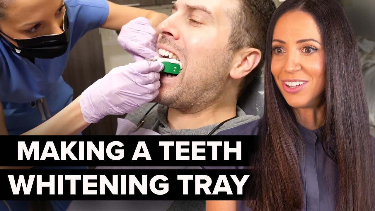 How Teeth Whitening Trays at the Dentist Are Made