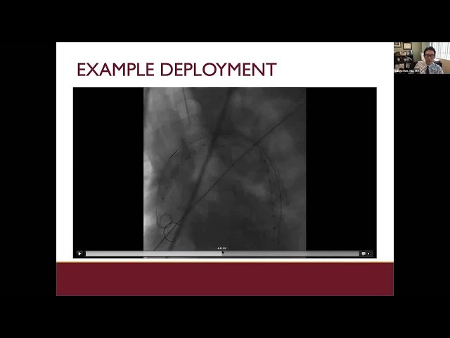 Mastering TEVAR Positioning: A Step-by-Step Guide to Type B Dissection ...