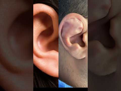 👂🥷Guess The Diagnosis: Hematoma of the ear after mixed martial arts (MMA) fighting.