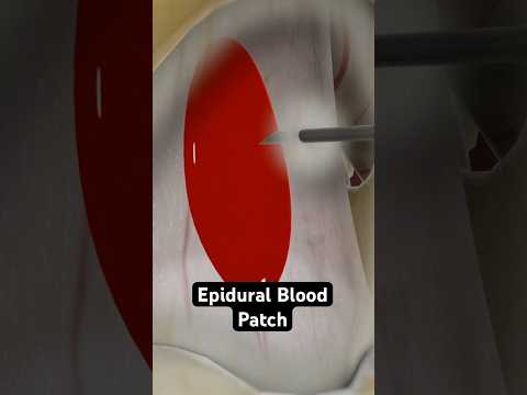 Patching a leaky spine - with blood! (3D Animation)