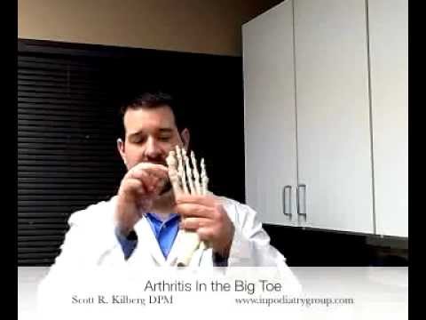 Arthritis In the Big Toe