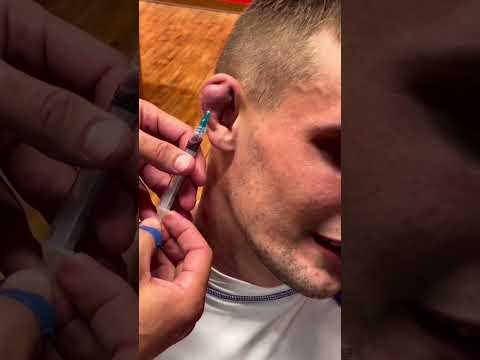 Cauliflower ear draining Pt. 2 ๐๐ผ ๐