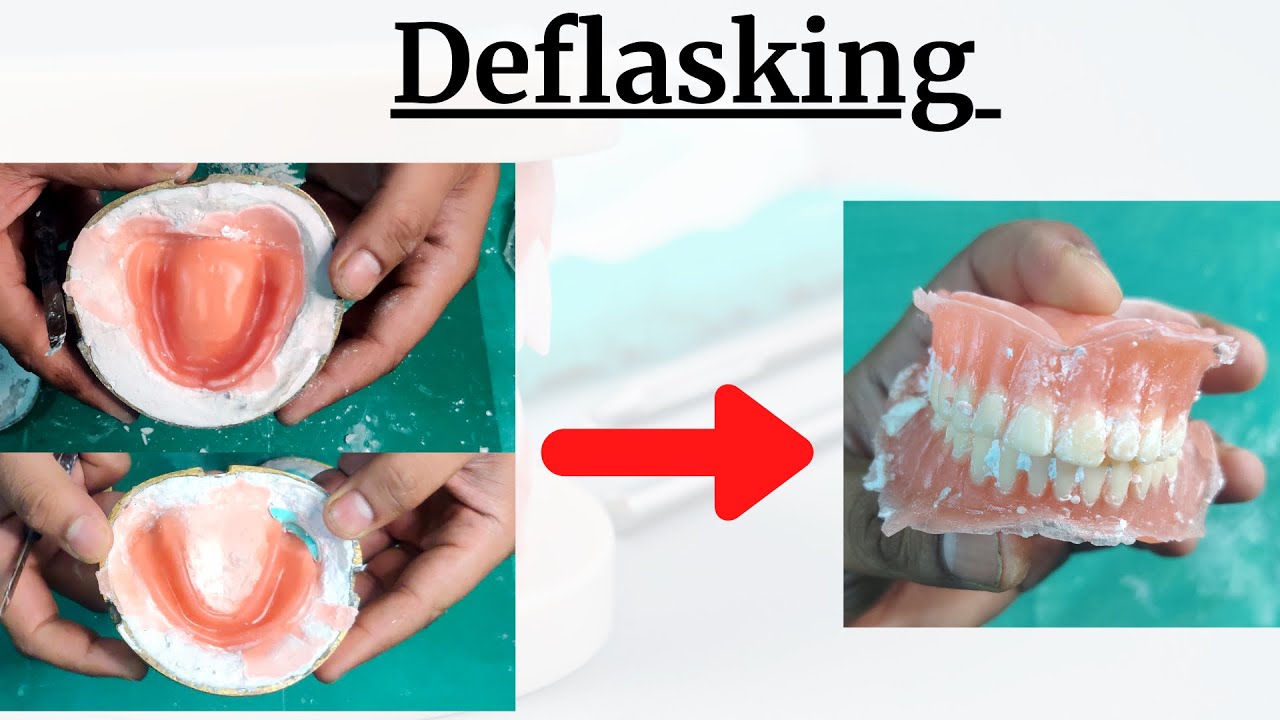 Deflasking of complete denture | Removal of denture from flask | Acrylisation of complete denture