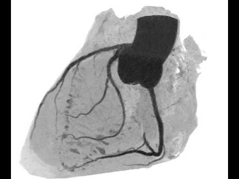 Cardiac CT Scan - Rotating Coronary Artery