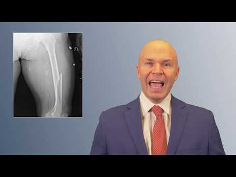 Settlement Value of Broken Leg Accident Cases