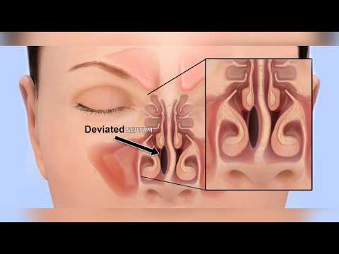Do you have a Deviated Septum?