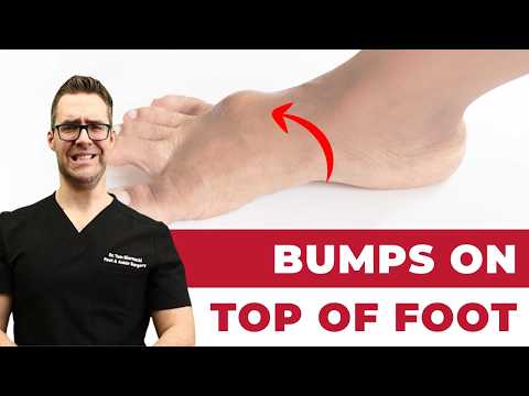 3 Causes of a Bump on Top of Foot | Balance Foot & Ankle