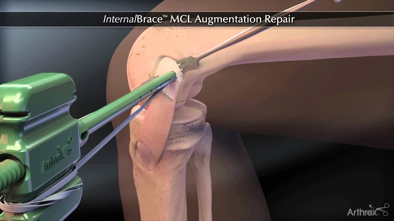 InternalBrace™ MCL Augmentation Repair