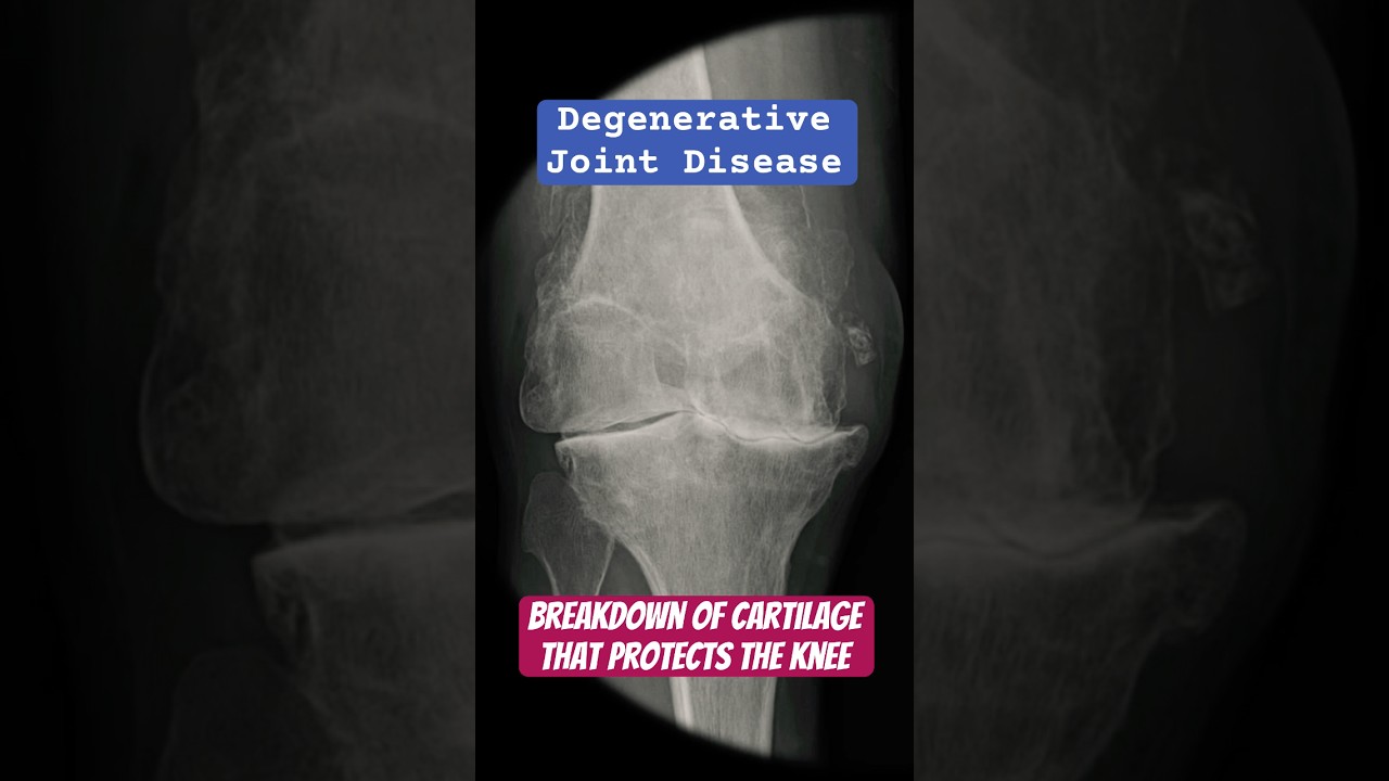 Degenerative Arthritis of the Knee