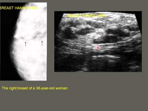 Case 4 Breast Hamartoma