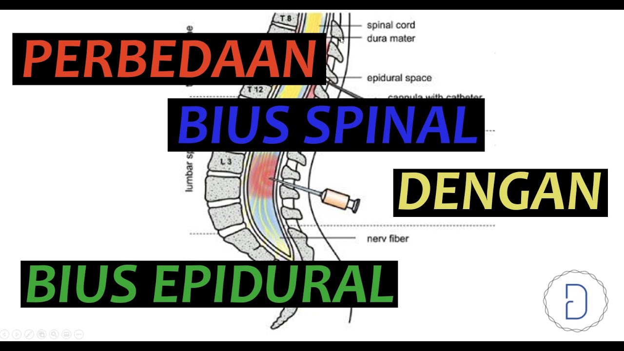 Perbedaan Pembiusan Spinal dengan Pembiusan Epidural