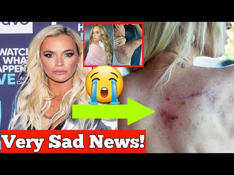 OMG ! Very Sad News😭! RHOBH’ Teddi Mellencamp’s Heartbreaking Skin Cancer Update.Very Shocking News!