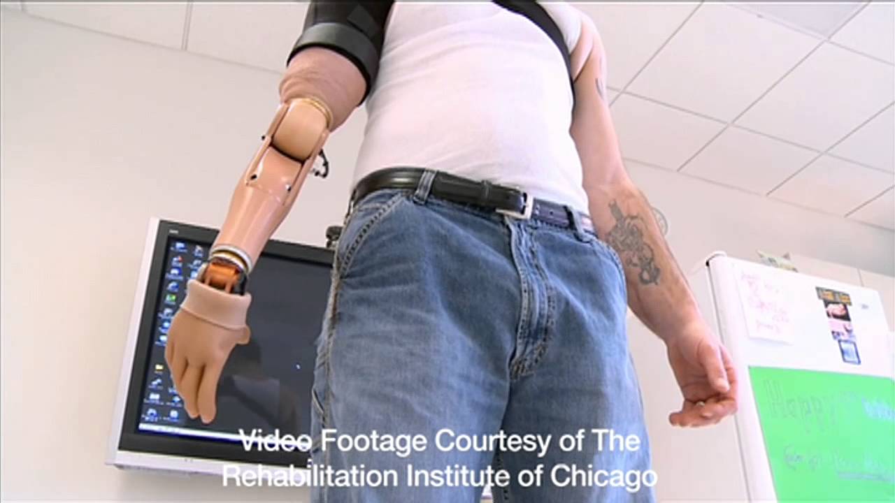 The Road to Recovery: Amputations and the Use of Prosthetics