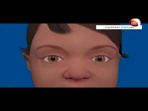 Eye surgery feature on Crossed eyes and Squints: A condition which the eyes are misaligned.